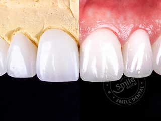 Veneer Composite là gì? So sánh Veneer Composite và Veneer Sứ | Nha ...